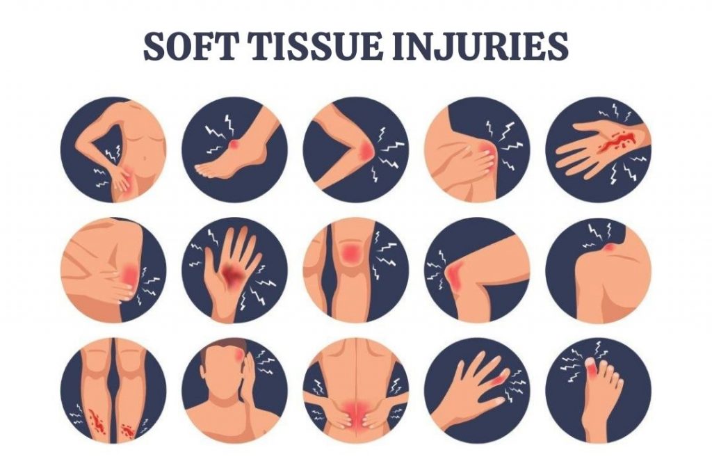 11 best tips for soft tissue injuries management 11 best tips for soft tissue injuries management